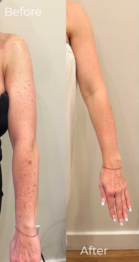 BBL (Broad Band Light) – Nouveau Med Spa